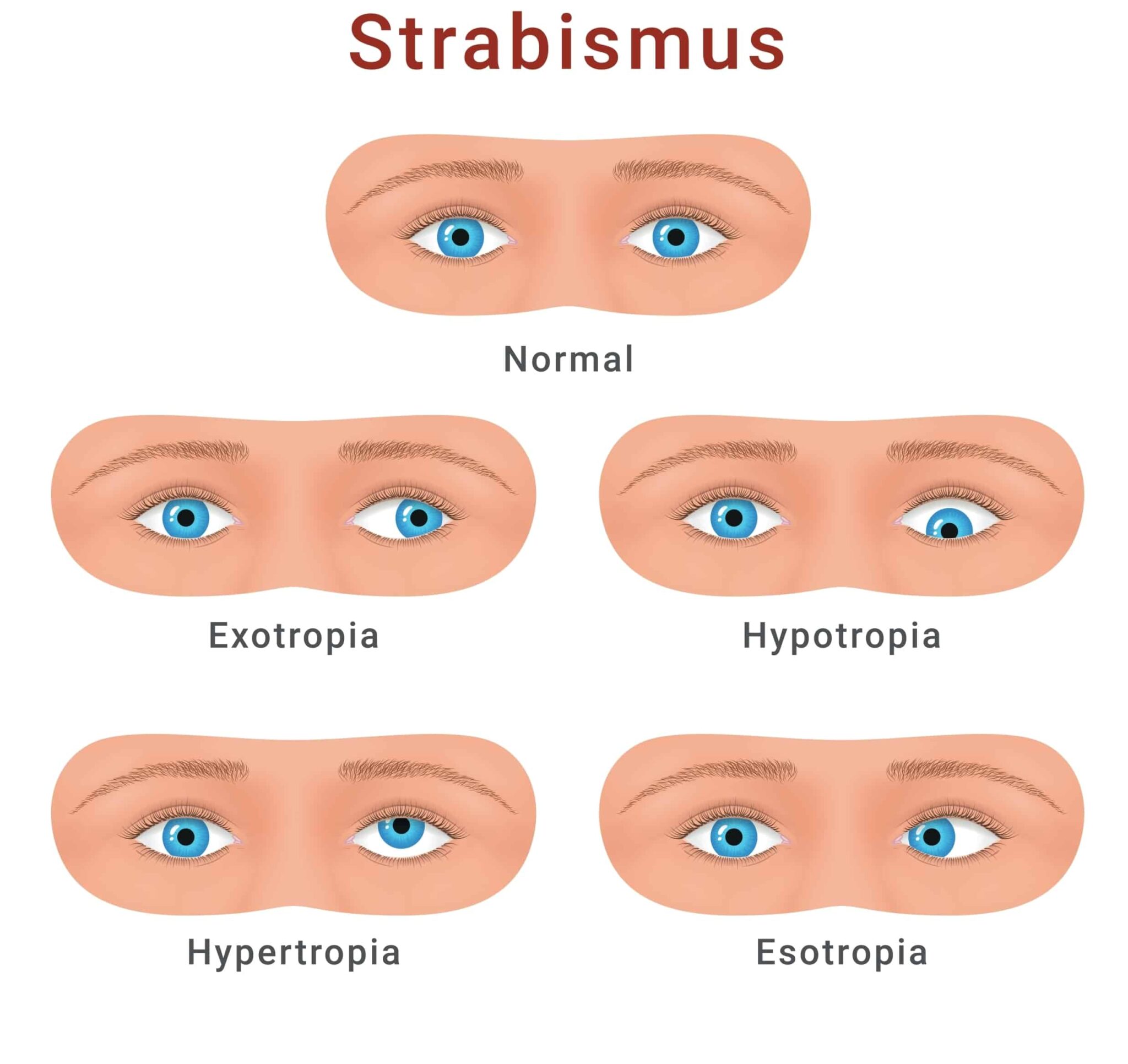 Pediatric Eye Care Seattle | Strabismus Sequim | Northwest Eye Surgeons